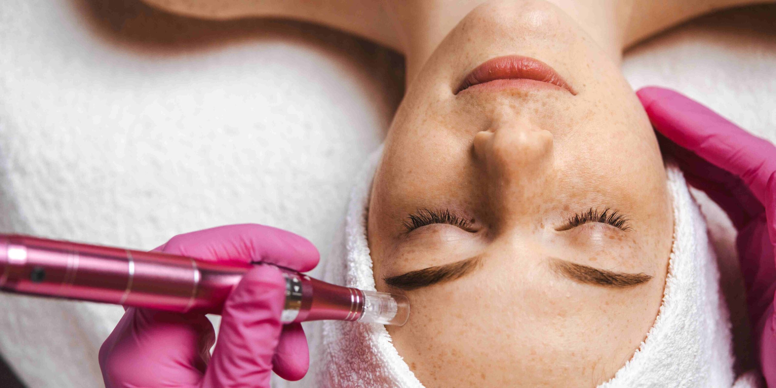 Microneedling With PRP Services in Potomac, Maryland - Potomac Medical ...